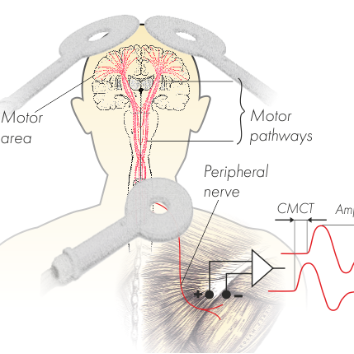Neuro-MS/D Advanced Therapeutic - Transcranial Magnetic Stimulator ...